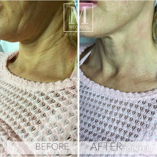 Absorbable Sutures: Non-Surgical Facelift — Monaco Medical Aesthetics