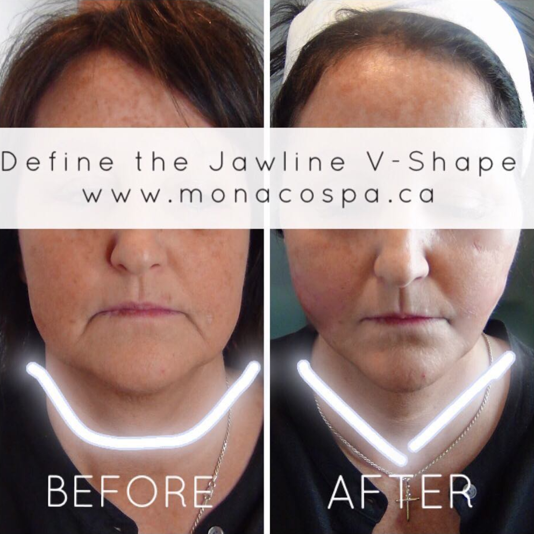 Absorbable Sutures: Non-Surgical Facelift — Monaco Medical Aesthetics