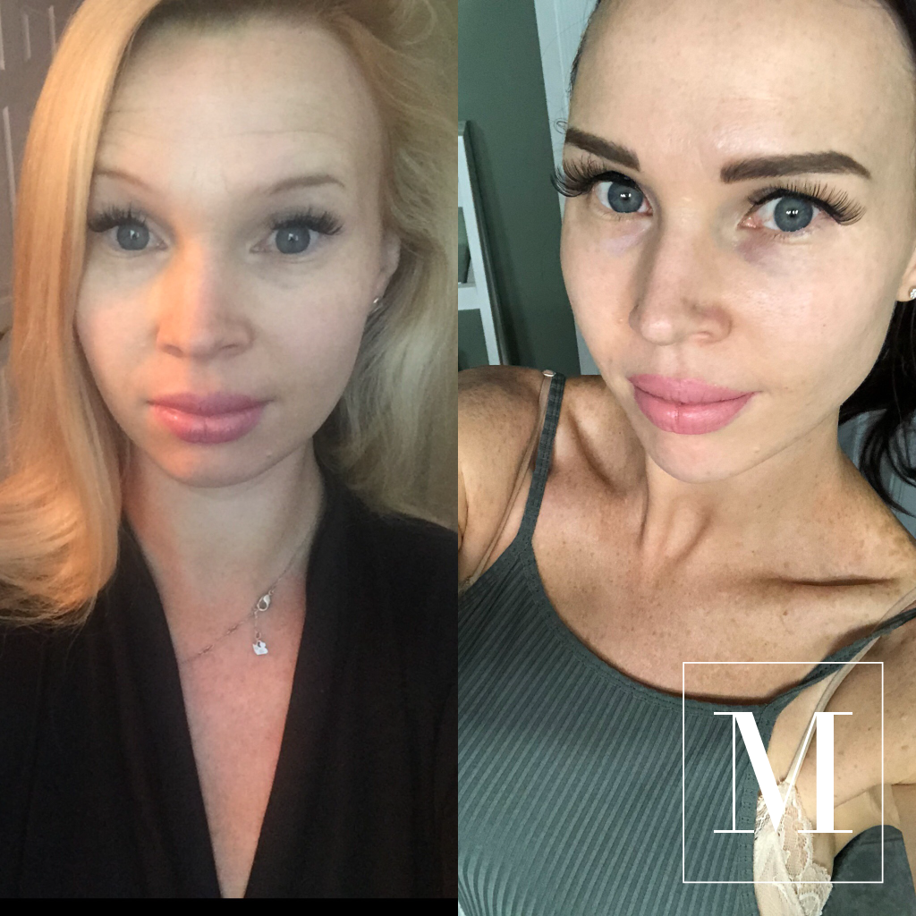 Platelet Rich Plasma Rejuvenation (PRP) - Vampire Facelift — Monaco ...