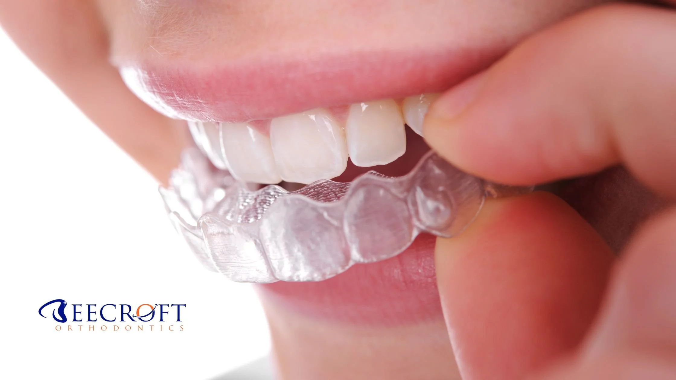 5 Best Tips for Taking Care of Your Permanent Retainer | Beecroft ...