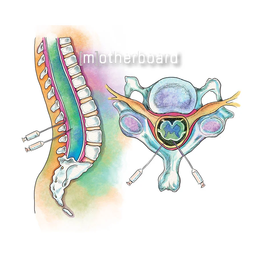 Epidurals and Spinals — Motherboard Birth