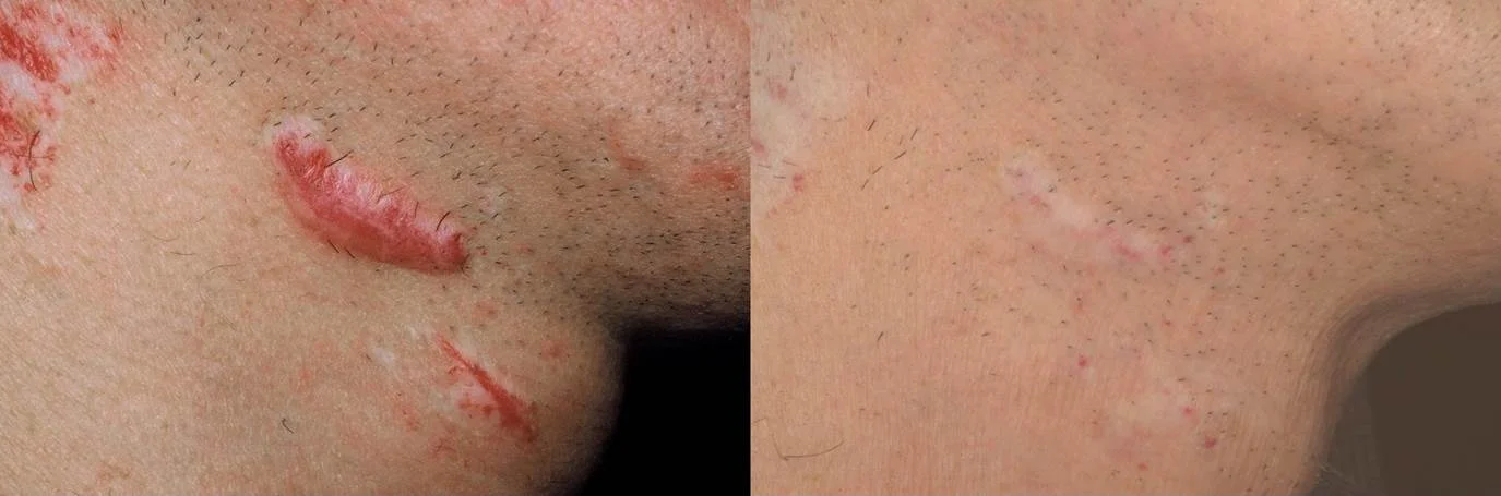Scar laser treatment — Physicians Laser and Dermatology Institute