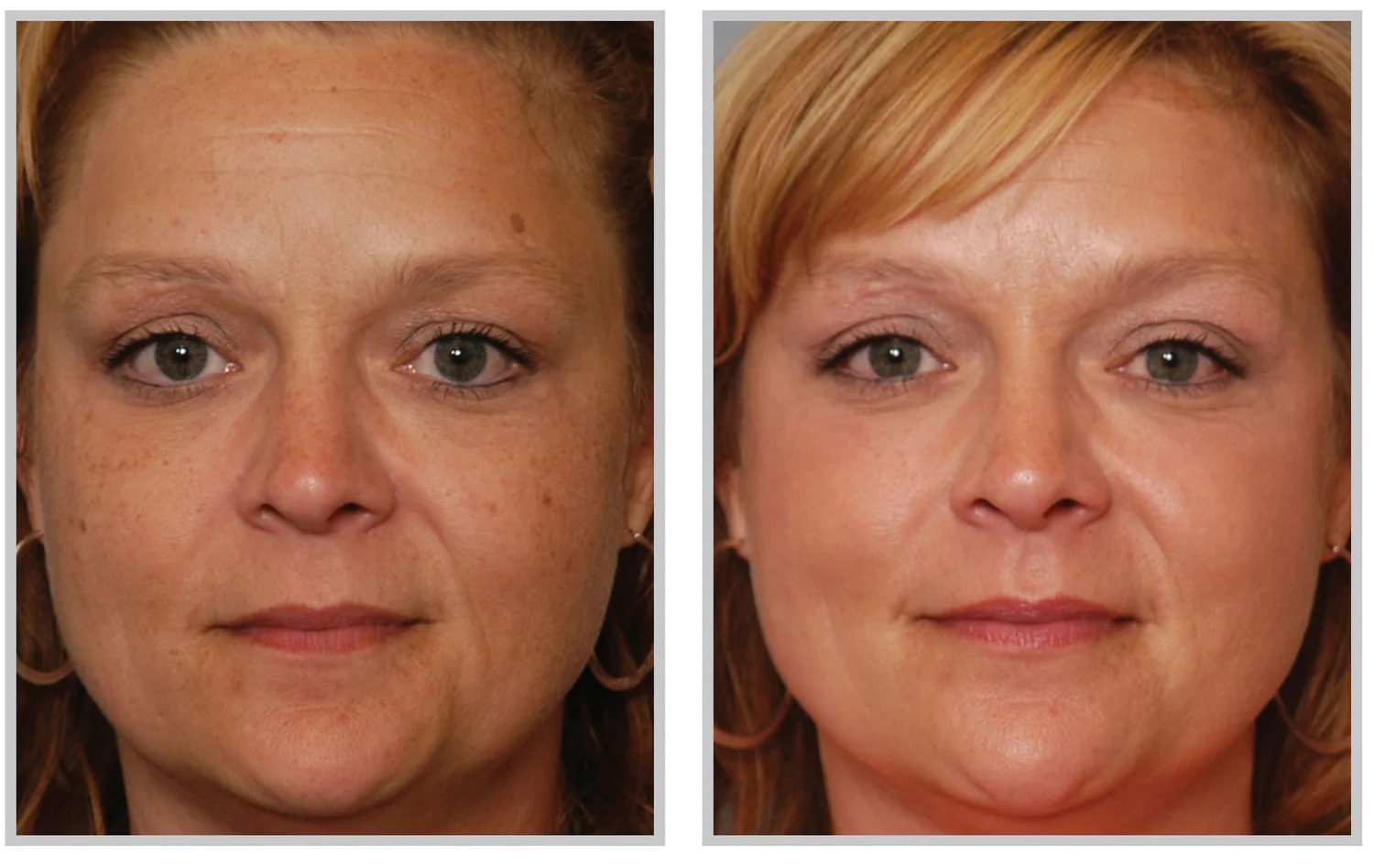 BBL Photo Rejuvenation — StrotherDermatology.com