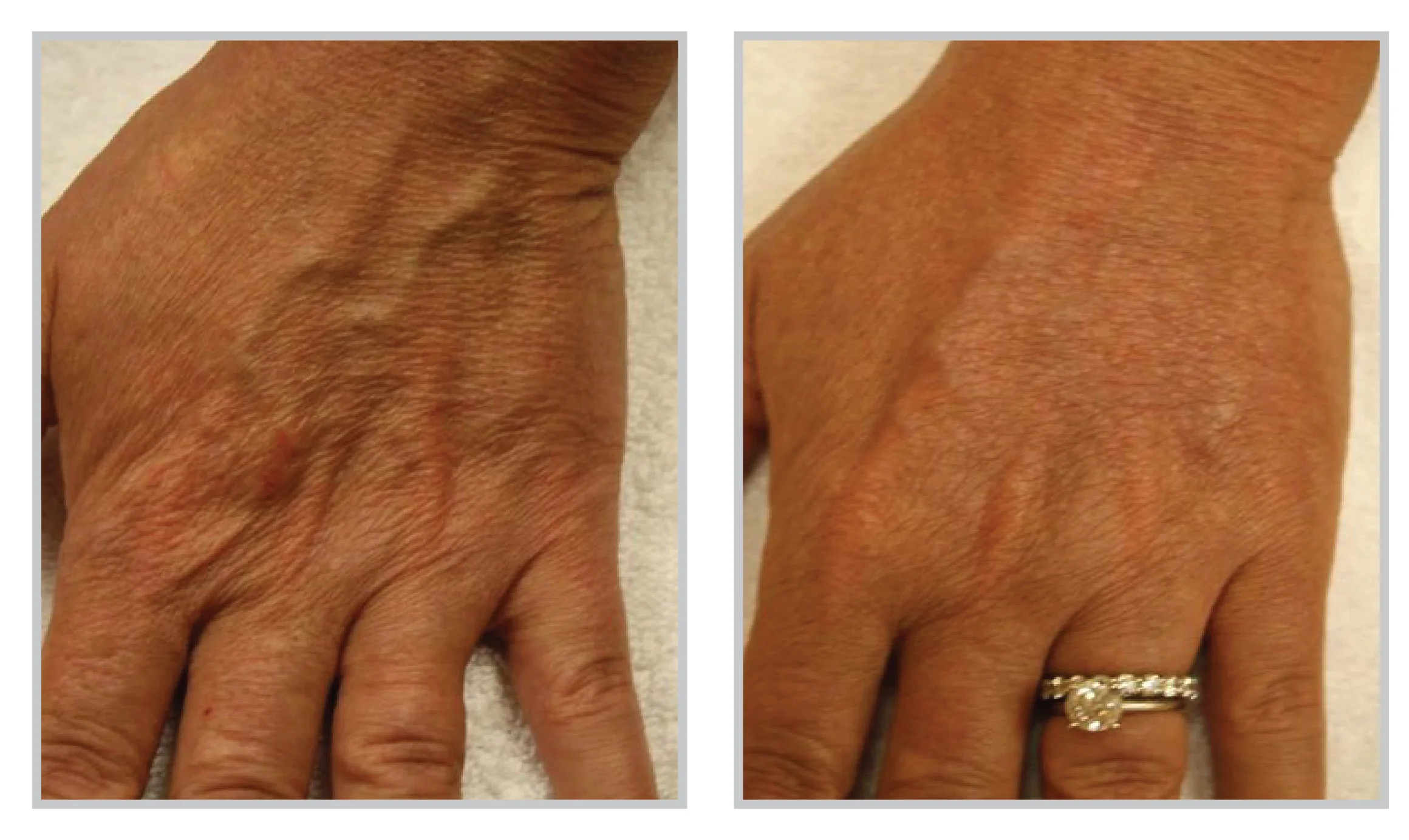 Halo Skin Resurfacing — StrotherDermatology.com