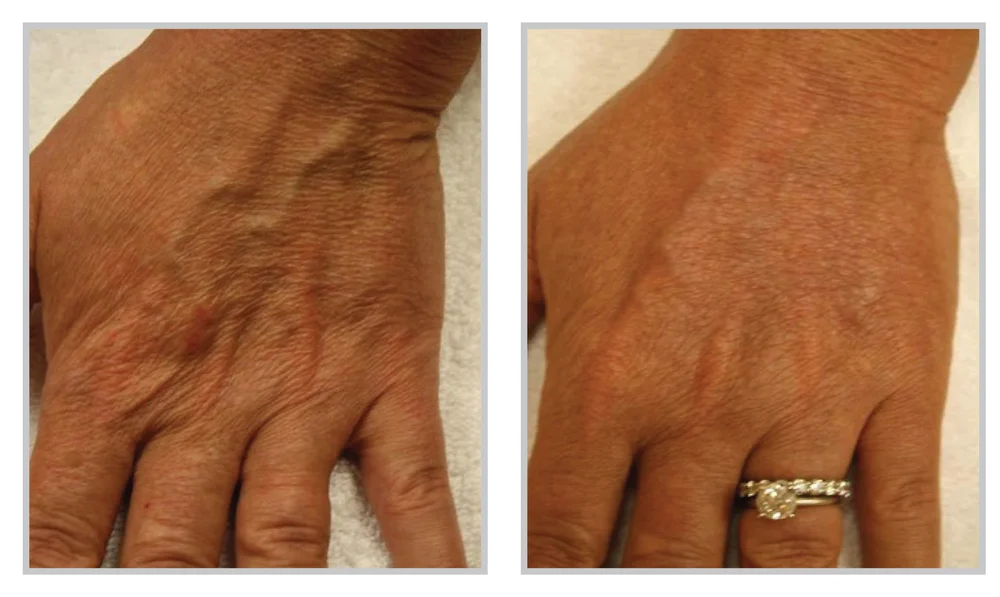 Halo Skin Resurfacing — StrotherDermatology.com