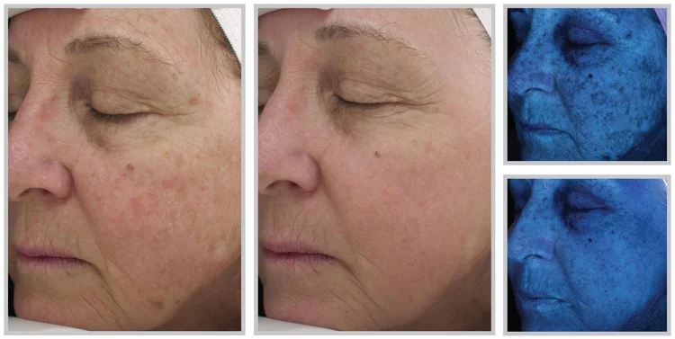 Halo Skin Resurfacing — StrotherDermatology.com