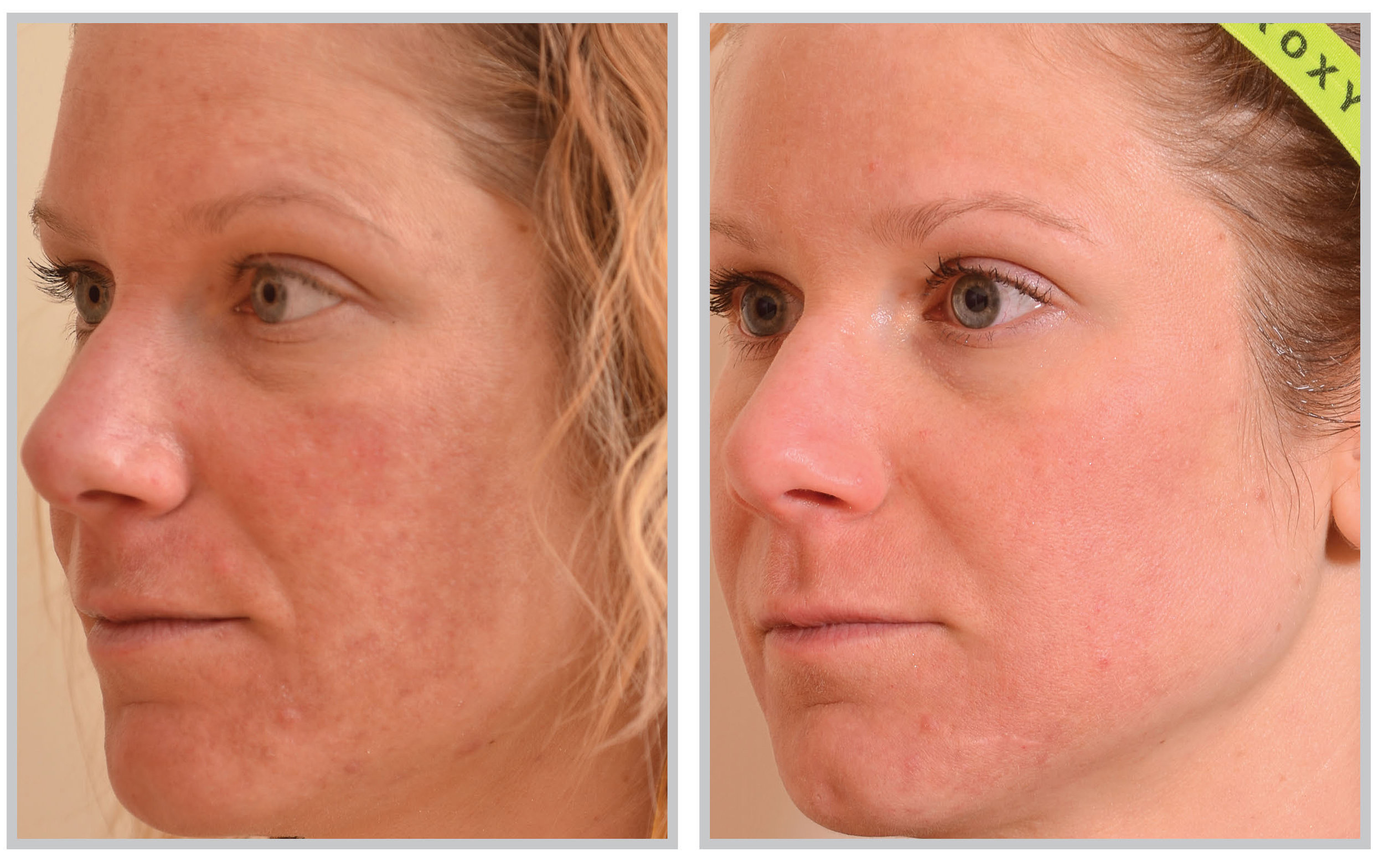 Halo Skin Resurfacing — StrotherDermatology.com