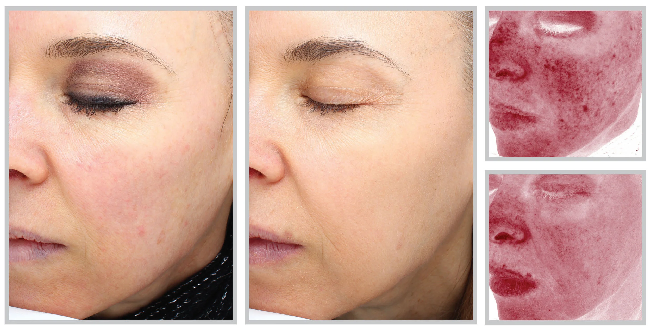 Halo Skin Resurfacing — StrotherDermatology.com