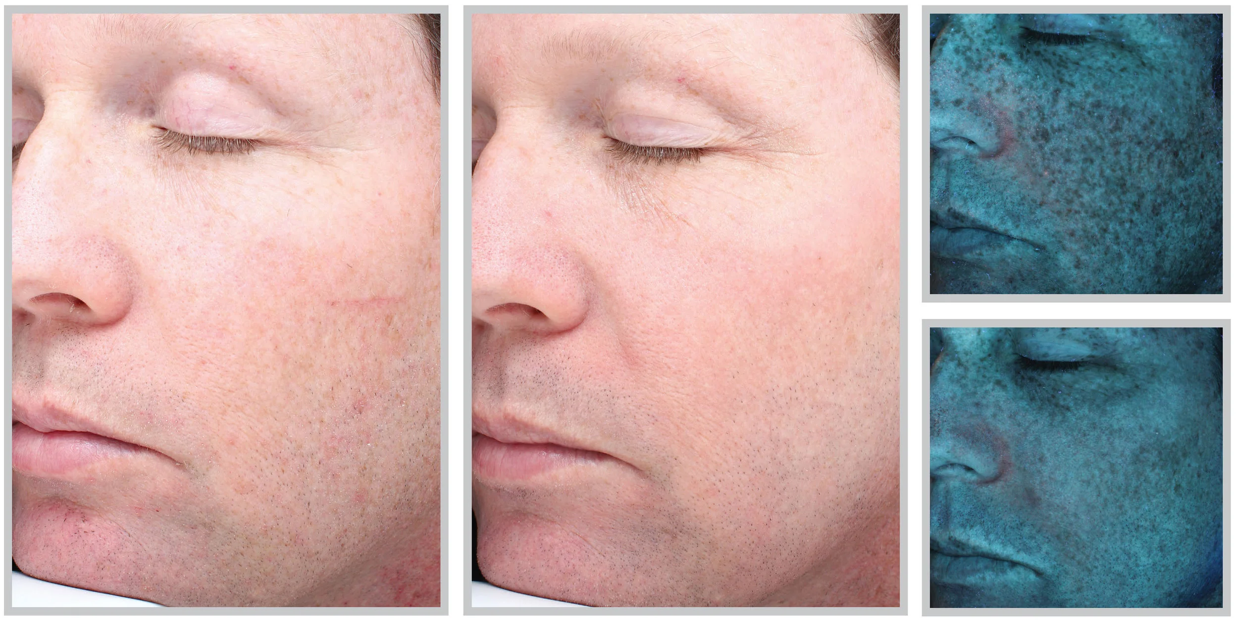 Halo Skin Resurfacing — StrotherDermatology.com
