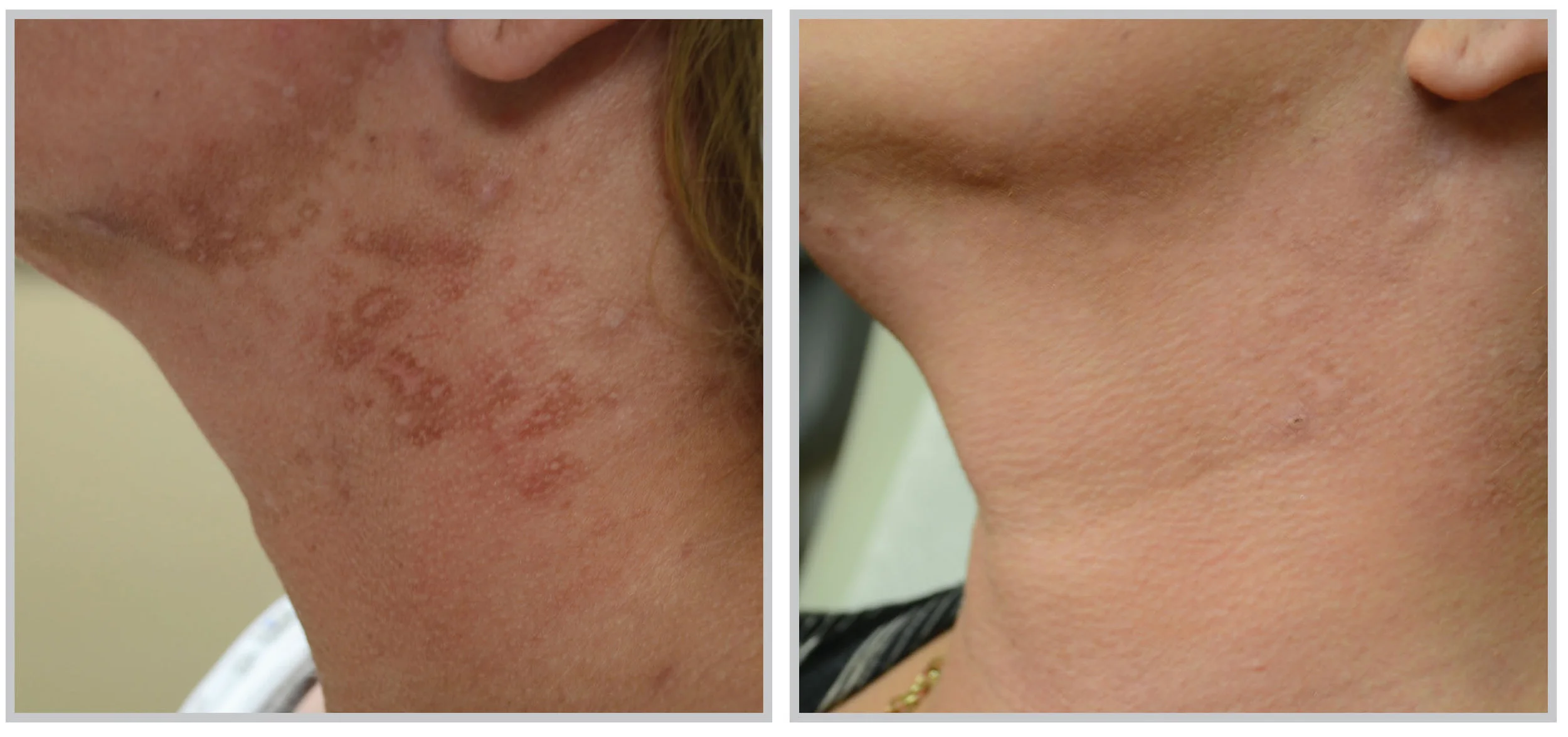 Halo Skin Resurfacing — StrotherDermatology.com