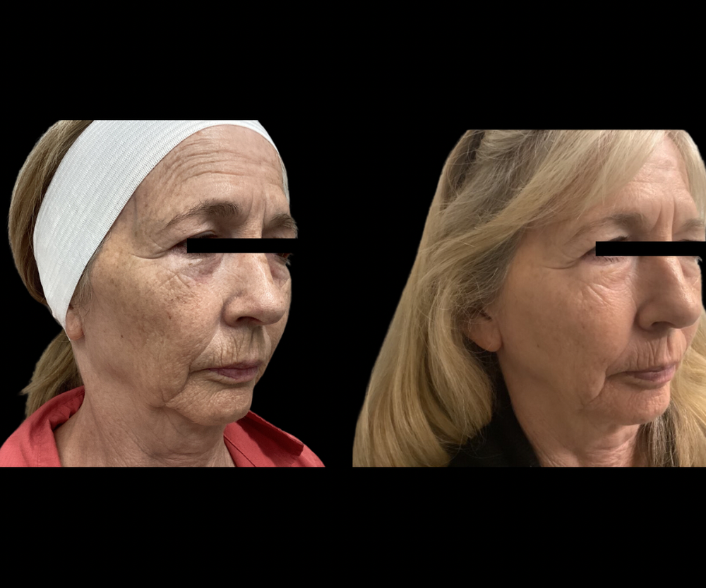 Skin Resurfacing — StrotherDermatology.com