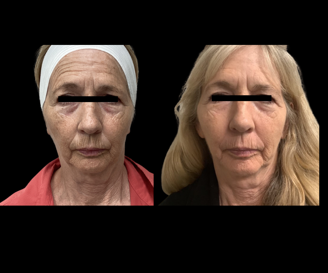 Skin Resurfacing — StrotherDermatology.com