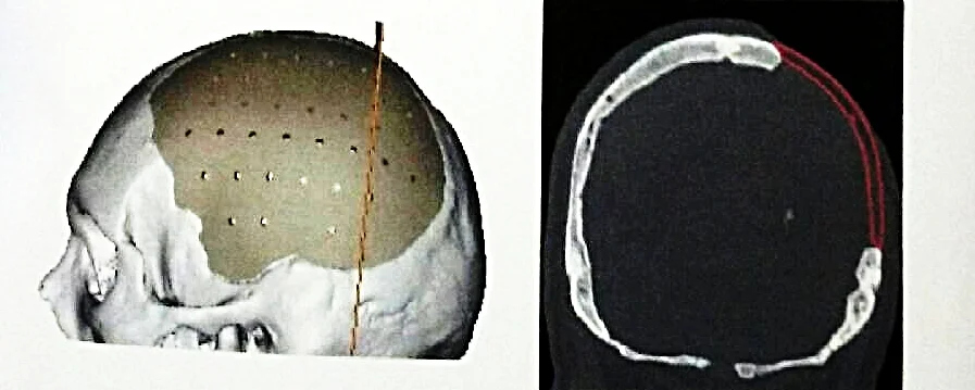 cranial — Palm Valley Brain and Spine Institute