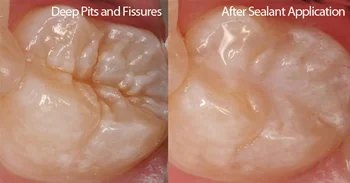 Fissure Seals | Seven Hills Dentist | Capstone Dental