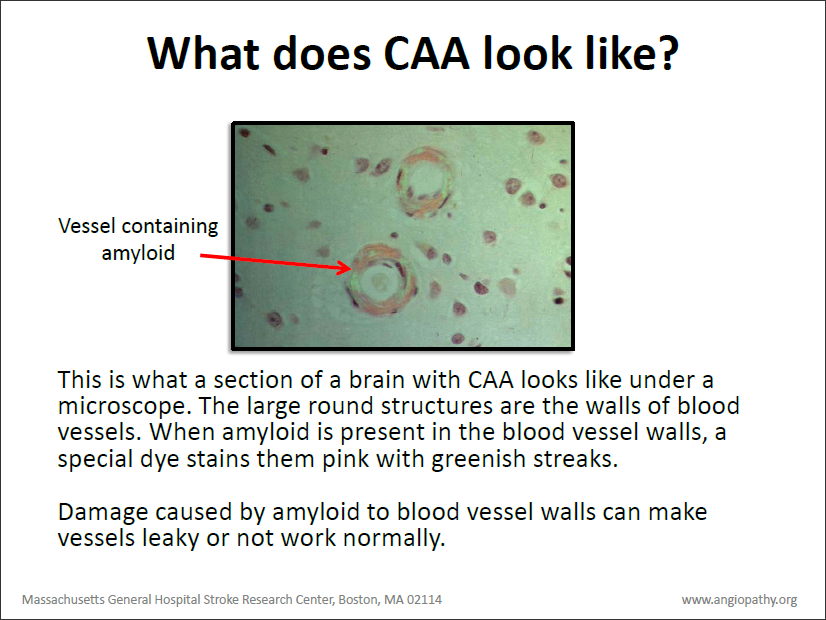 What is CAA? — Cerebral Amyloid Angiopathy