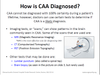 What is CAA? — Cerebral Amyloid Angiopathy