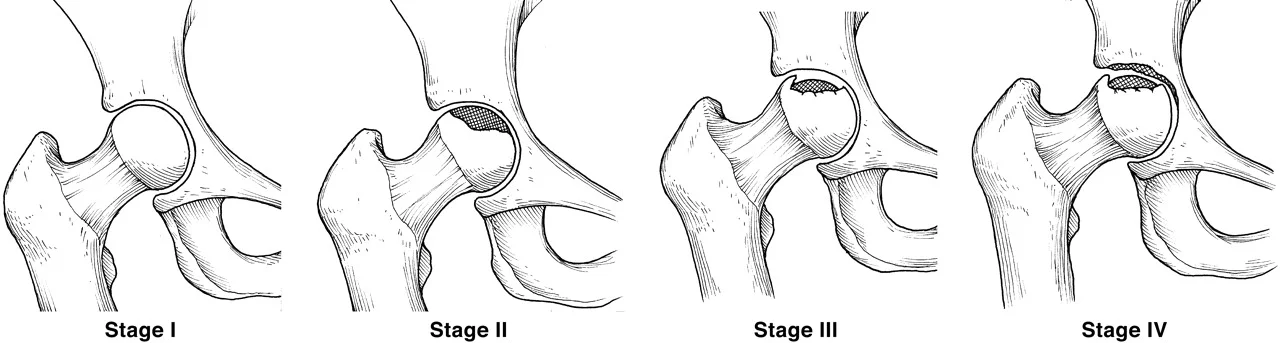 Avascular Necrosis (AVN) of the Femoral Head — Andrew Dold, MD ...