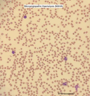 TTP & MAHA — HaemBase