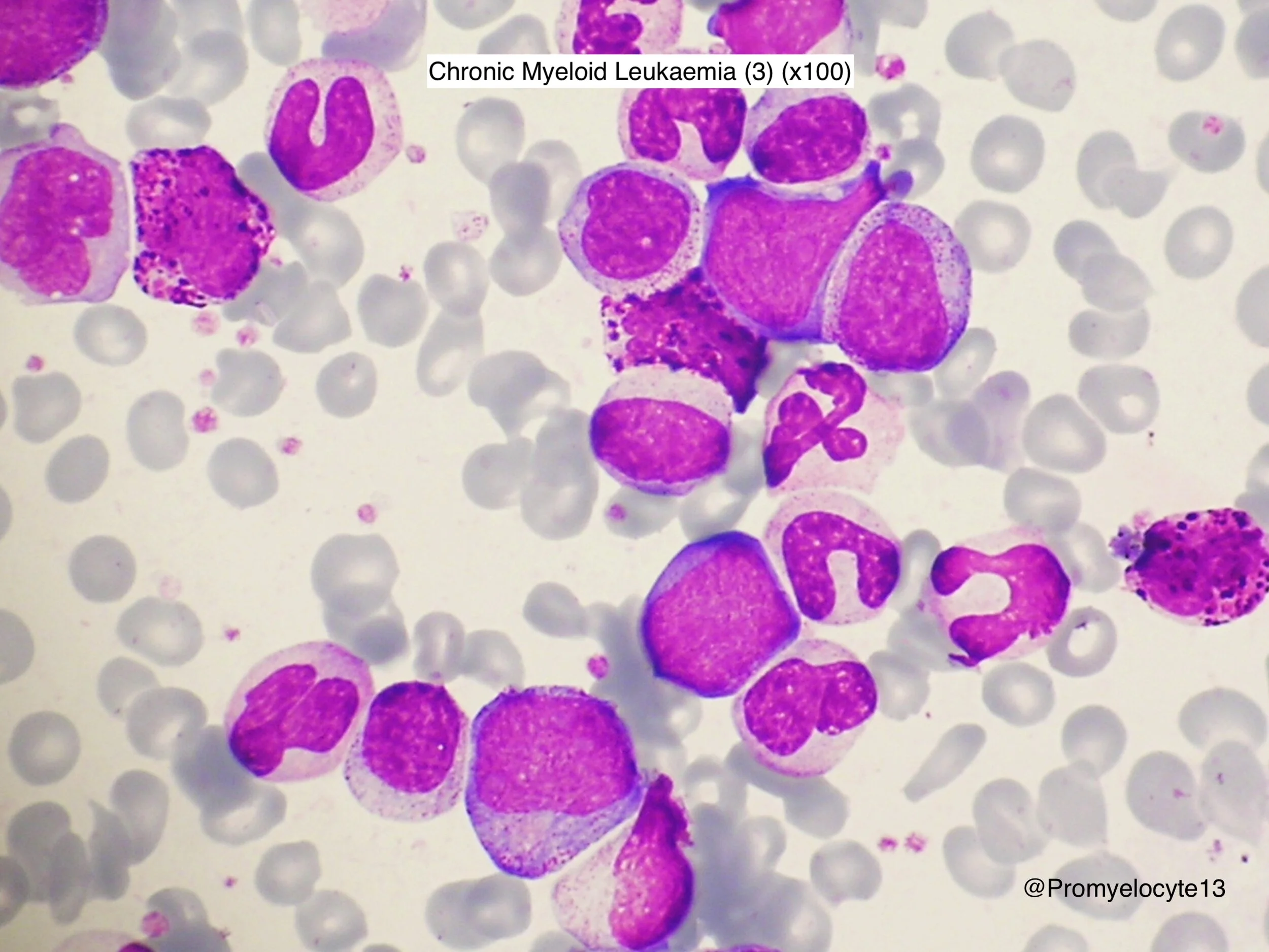 CML HaemBase