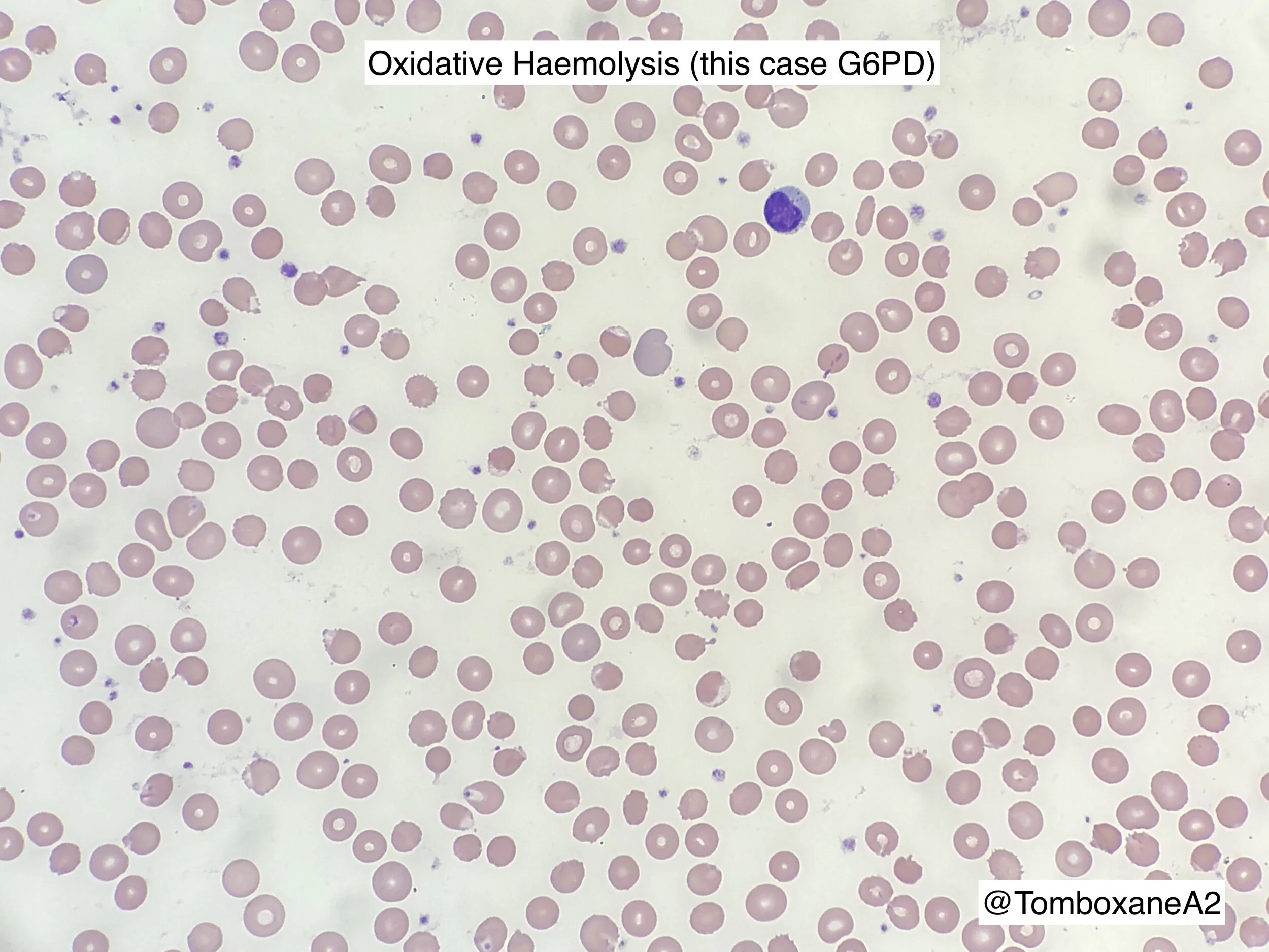 Oxidative Haemolysis — HaemBase