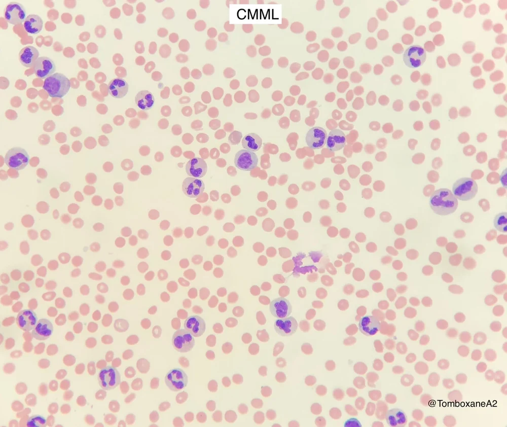 CMML — HaemBase
