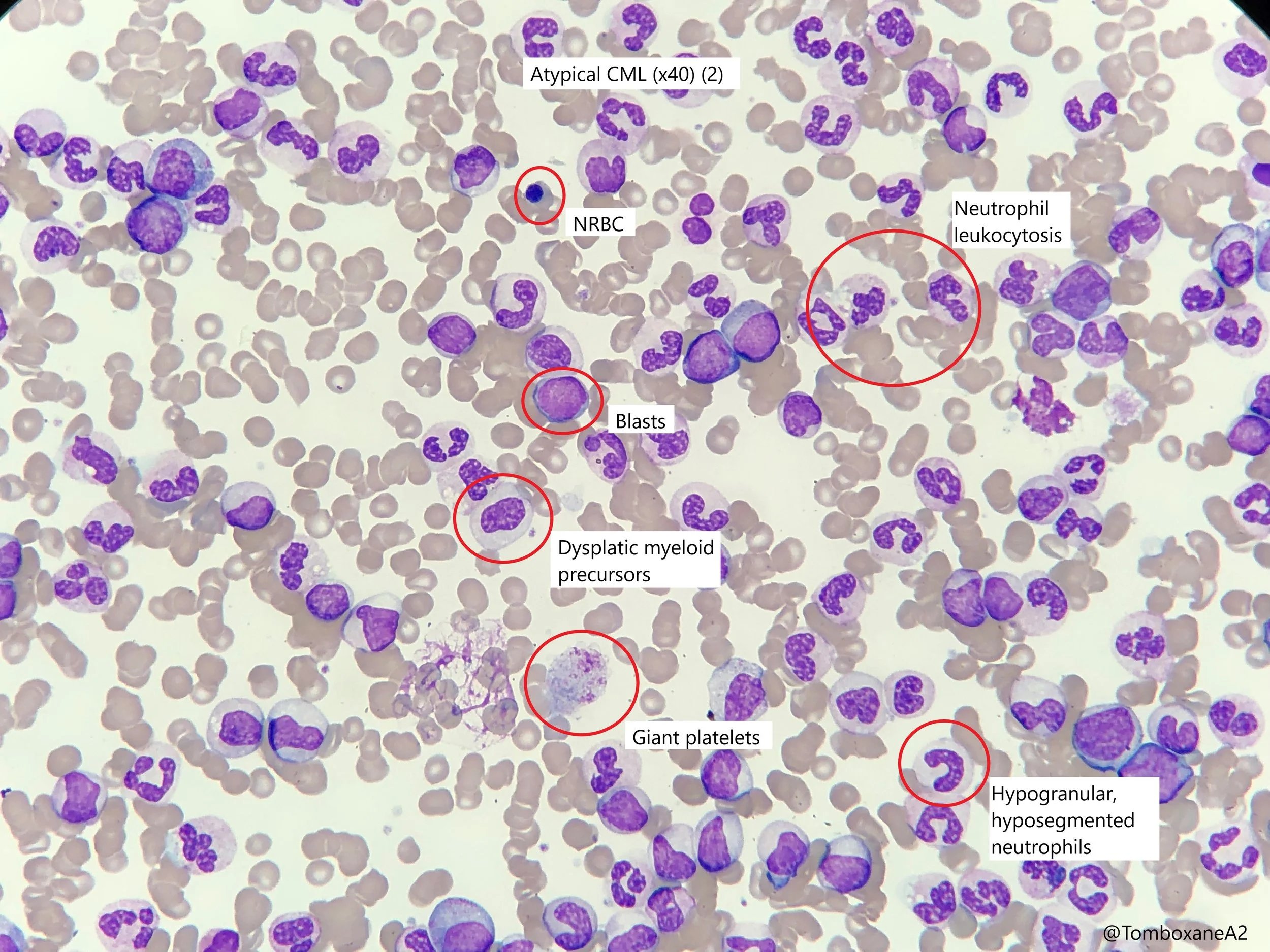 Peripheral Blood — HaemBase