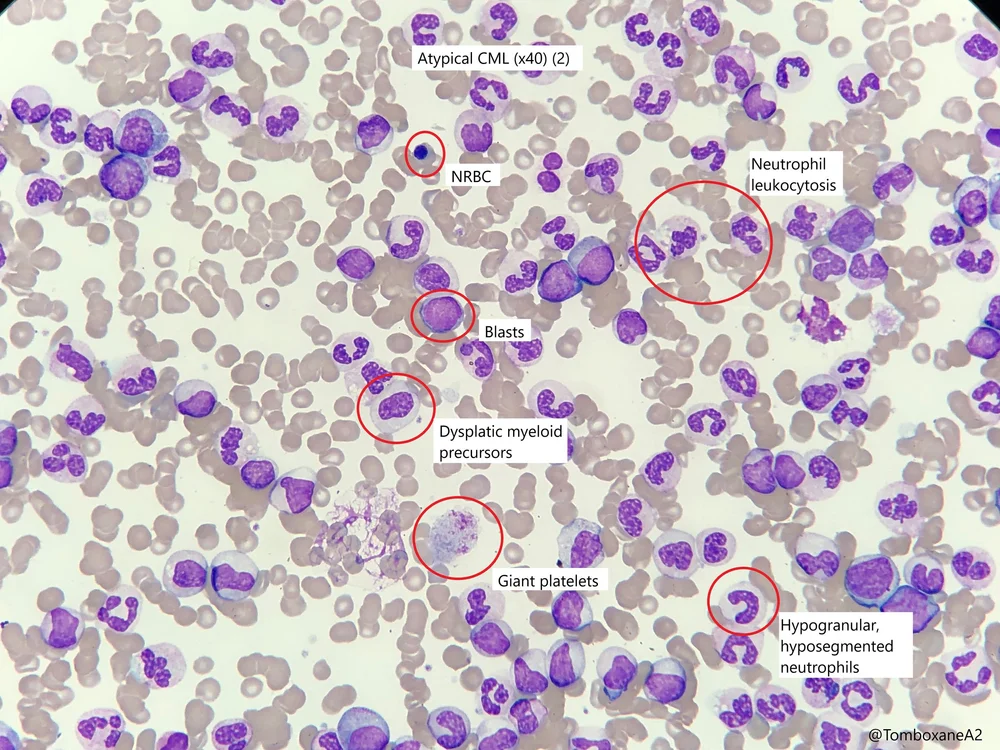 Atypical CML — HaemBase