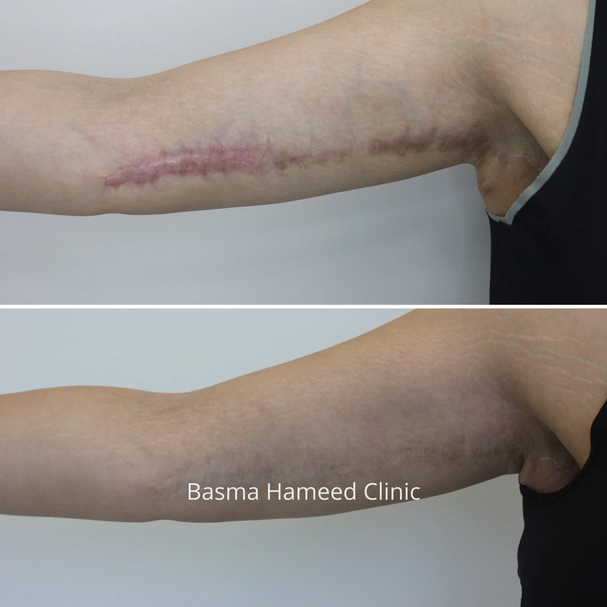 Keloid Treatment — Basma Hameed Clinic