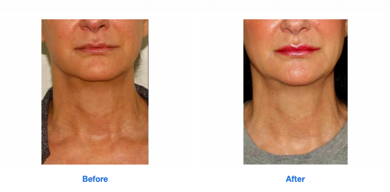 Ultrasound and Radiofrequency Skin Tightening — Midwest Laser Centre