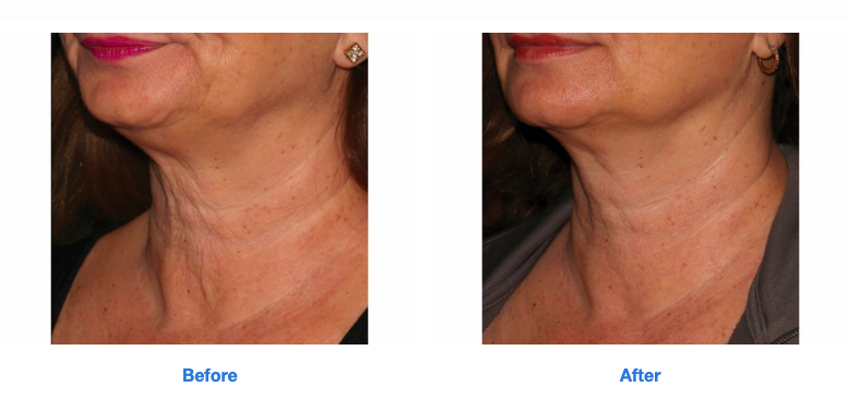 Ultrasound and Radiofrequency Skin Tightening — Midwest Laser Centre