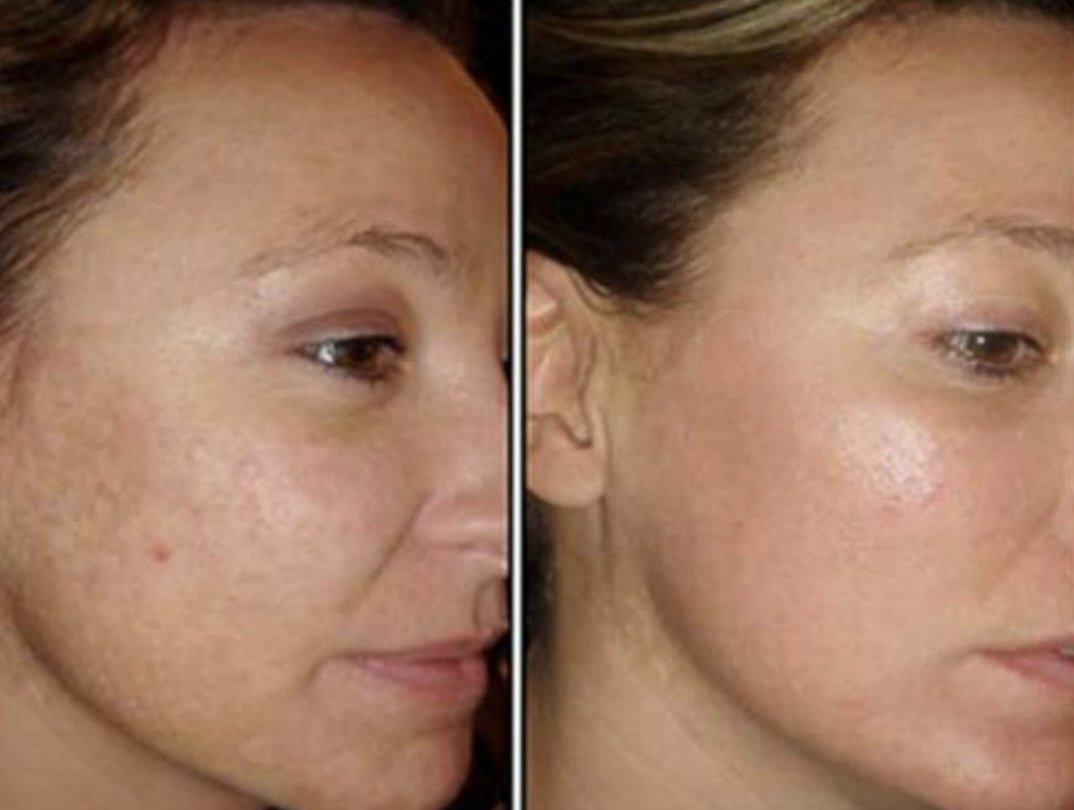 RF Microneedling — Midwest Laser Centre