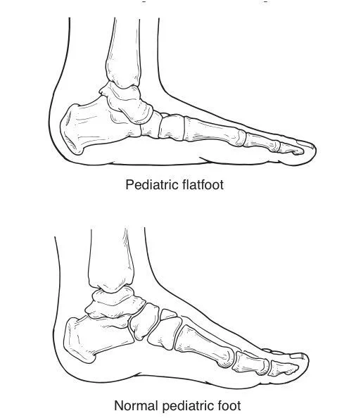Pediatric Flat Foot — Milestone Pediatric Therapy