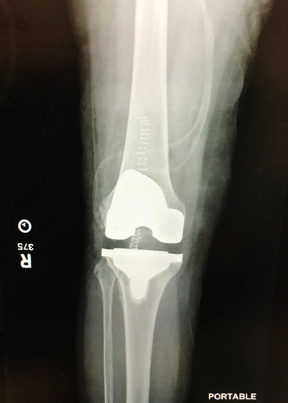 Total Knee Replacement: A Survivor's Guide —18. Recovery, Stage I