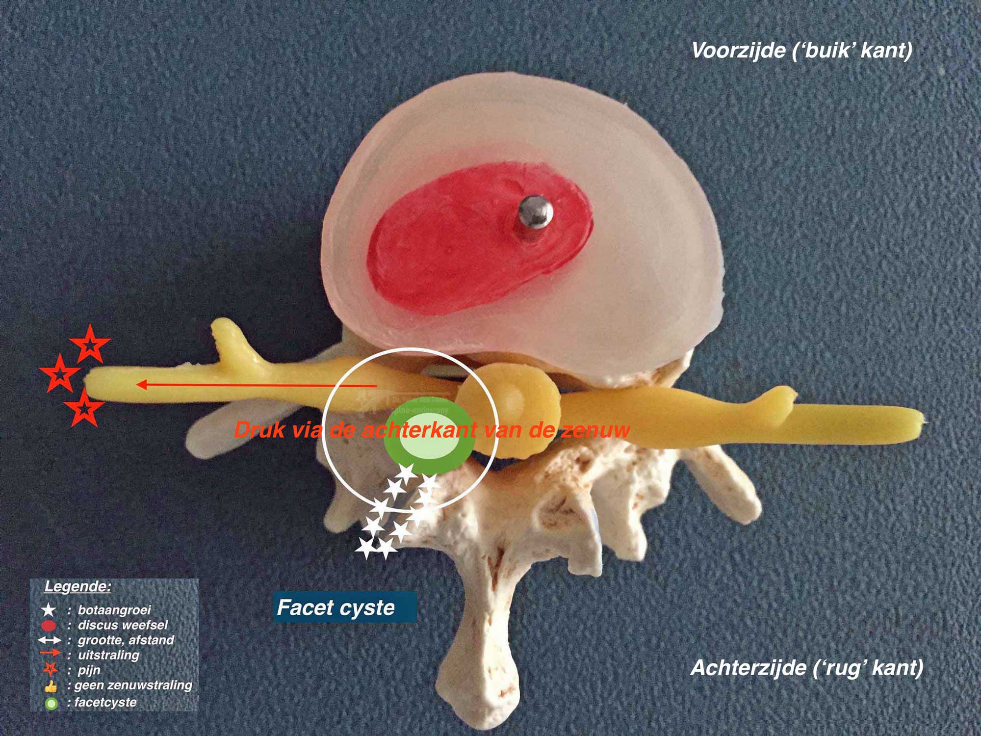 Facet- & synoviale wervelcyste: oorzaak, klachten & behandeling | Dr ...