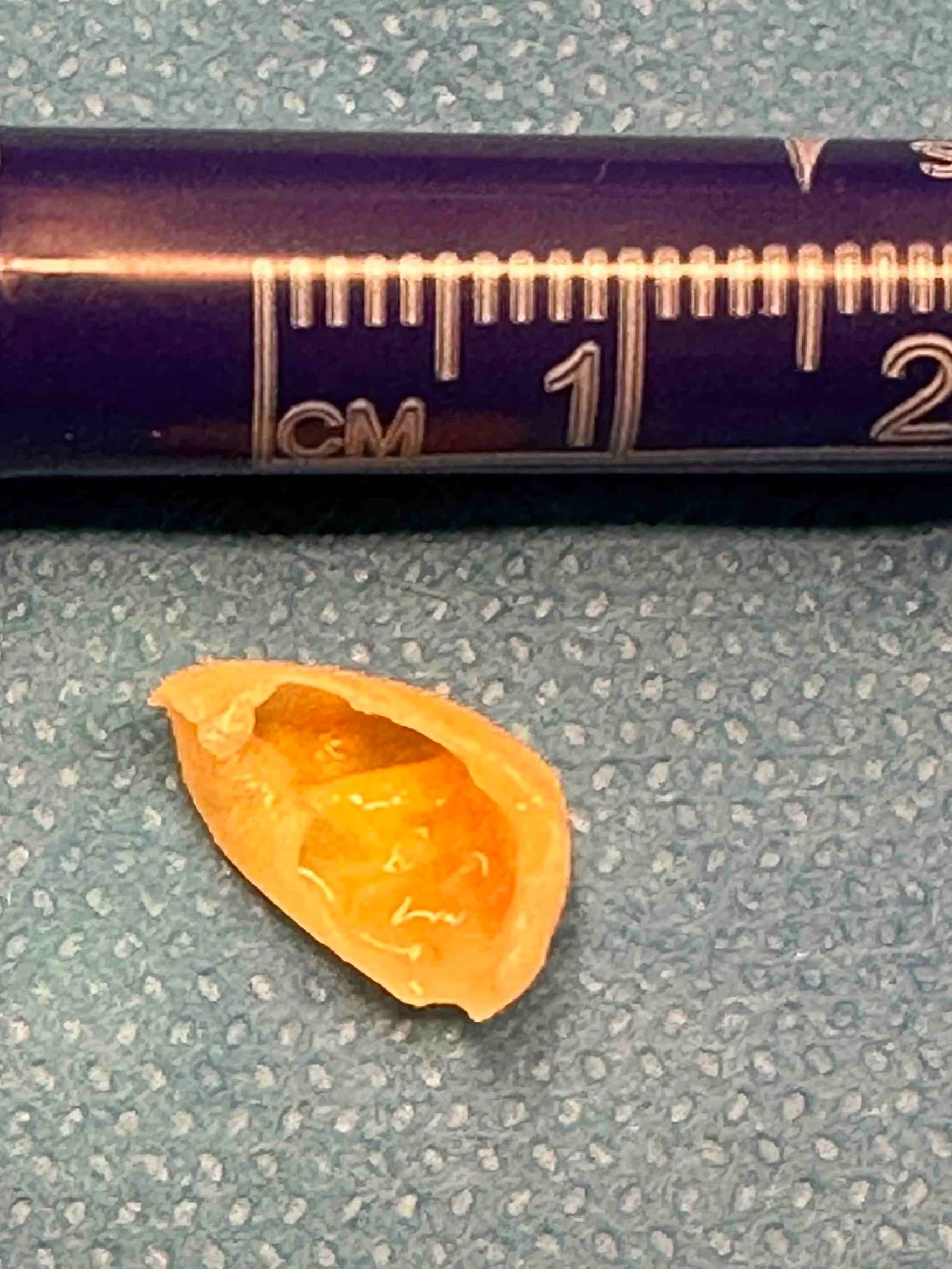 Facet- & synoviale wervelcyste: oorzaak, klachten & behandeling | Dr ...