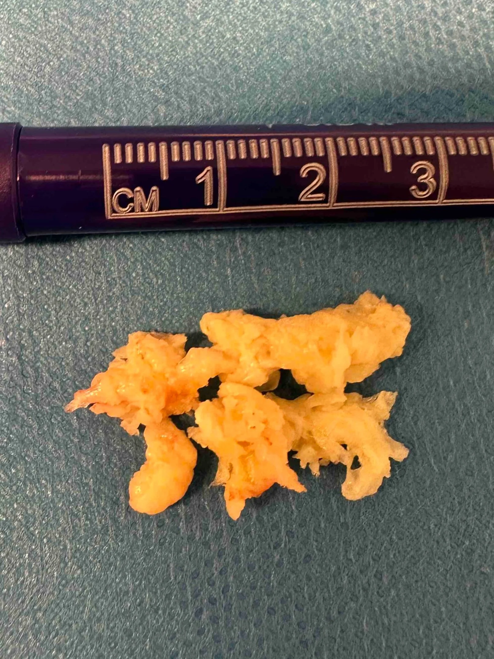 Discus hernia behandelen met full-endoscopie | Dr. Peter Van Daele ...