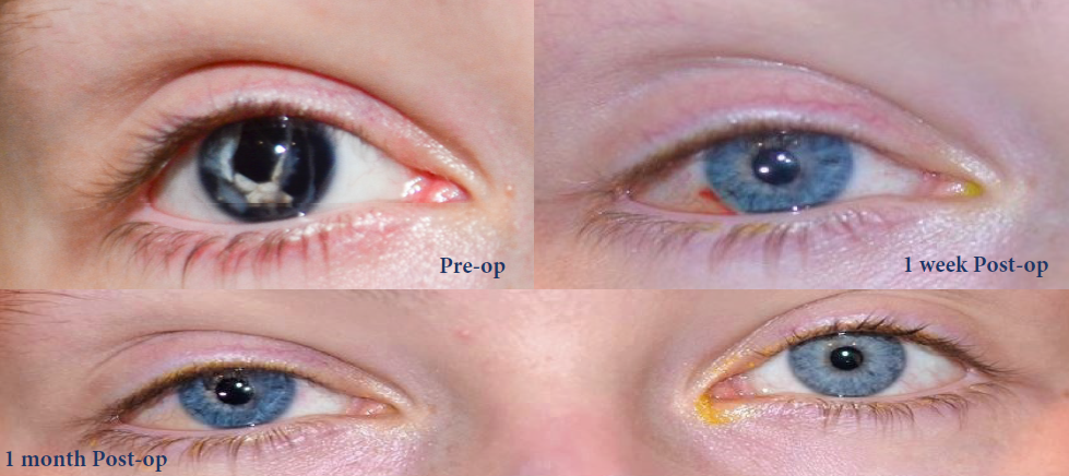 CFAI Patient Page — VEO Ophthalmics