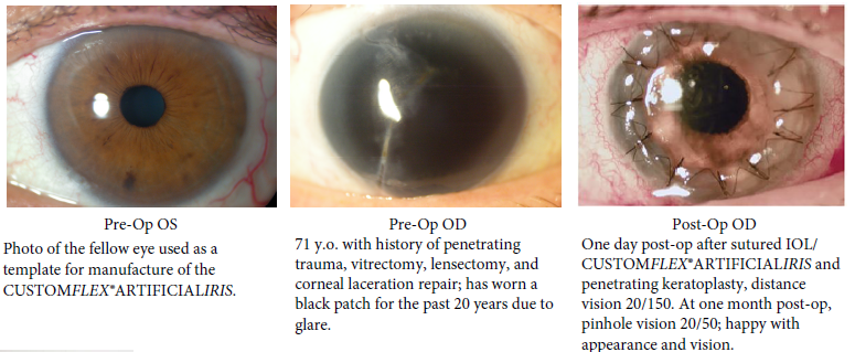 CFAI Patient Page — VEO Ophthalmics