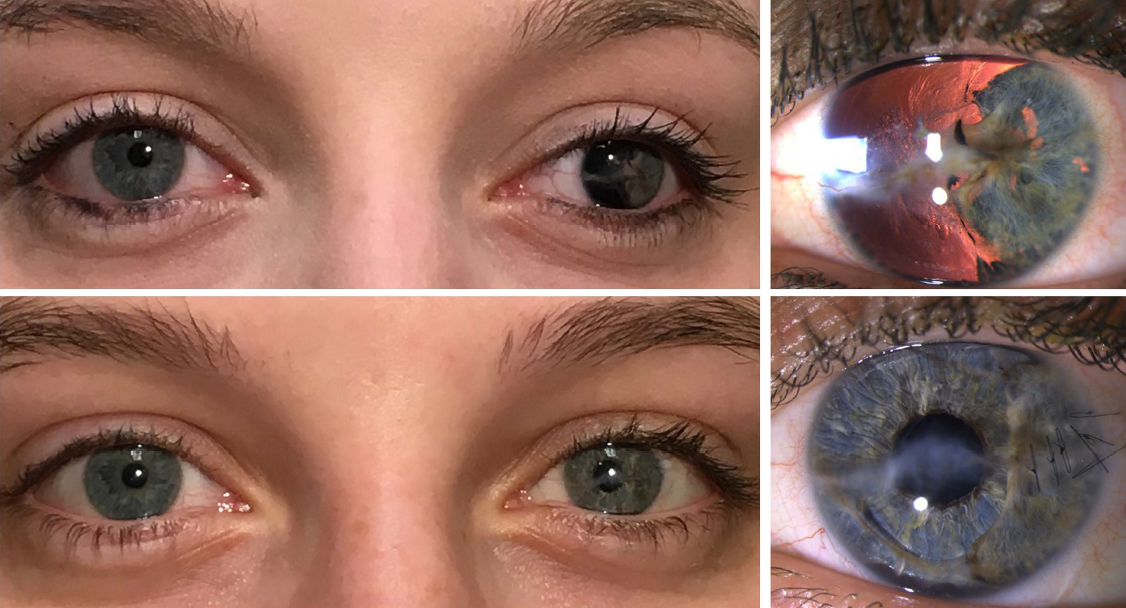 CFAI Patient Page — VEO Ophthalmics