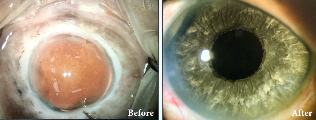 CUSTOMFLEX® ARTIFICIALIRIS — VEO Ophthalmics