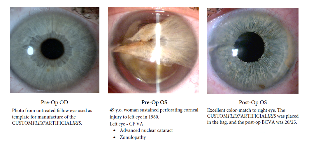 CUSTOMFLEX® ARTIFICIALIRIS — VEO Ophthalmics