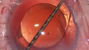 CUSTOMFLEX® ARTIFICIALIRIS — VEO Ophthalmics