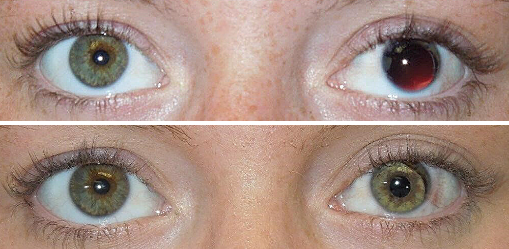 CUSTOMFLEX® ARTIFICIALIRIS — VEO Ophthalmics