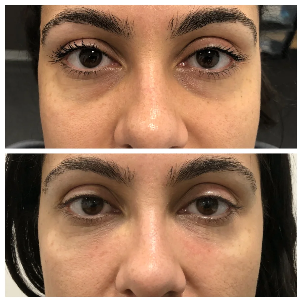 Are Tear Trough Fillers the Secret to a Fresh Face? — Editor's Beauty