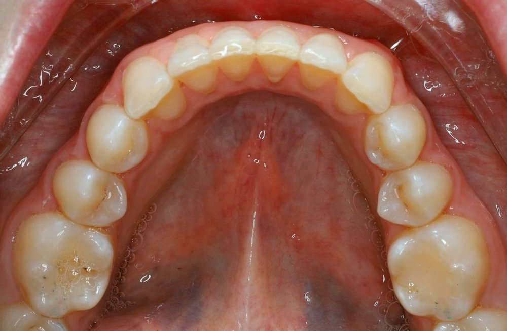 Aligners and Orthodontics — Shumack Dental & Implants