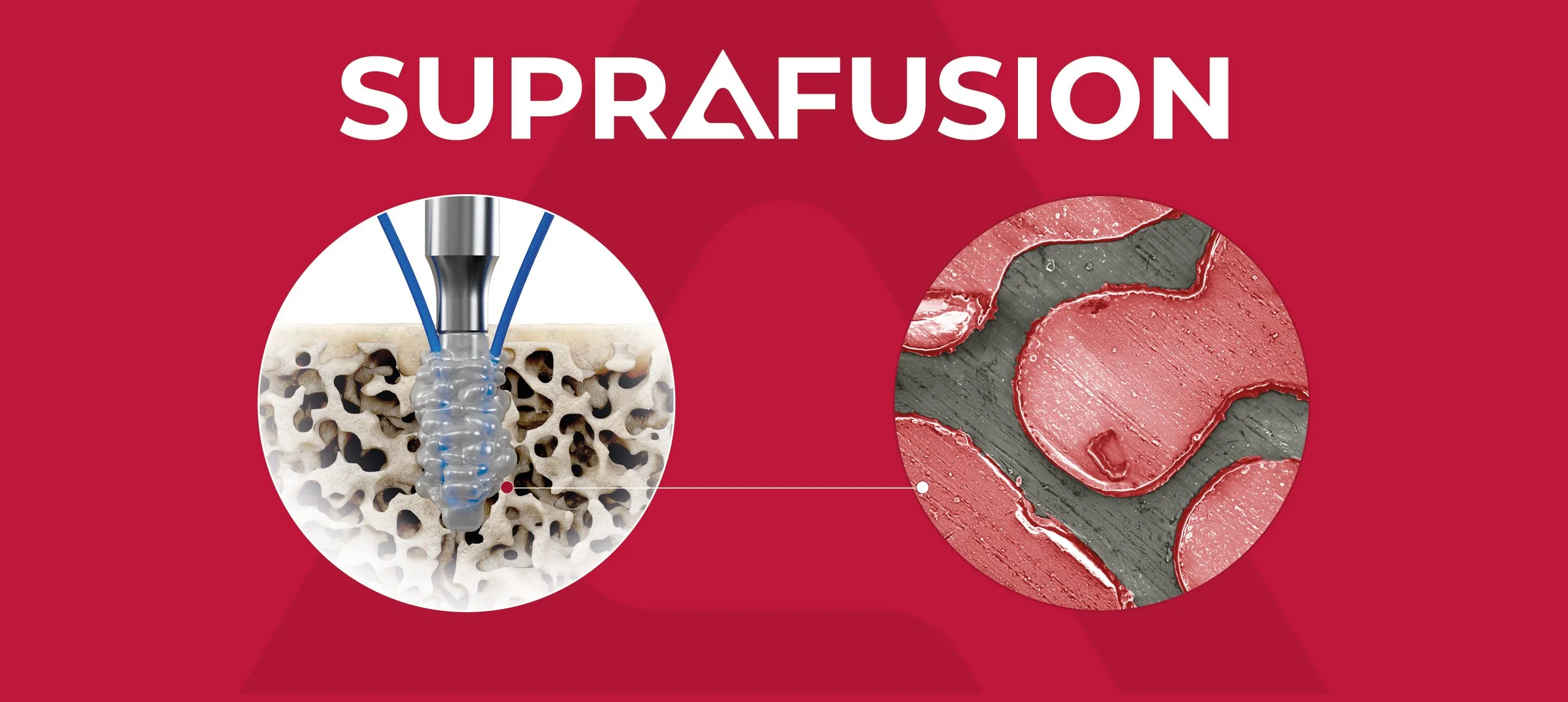 Redefine the paradigm for soft tissue fixation: tailor the implant to ...