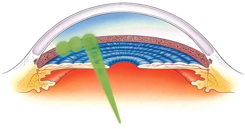 Selective Laser Trabeculoplasty — NEW WEST EYES