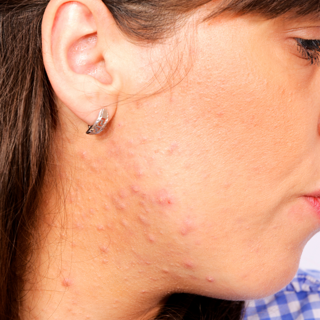Stress Hives On Face