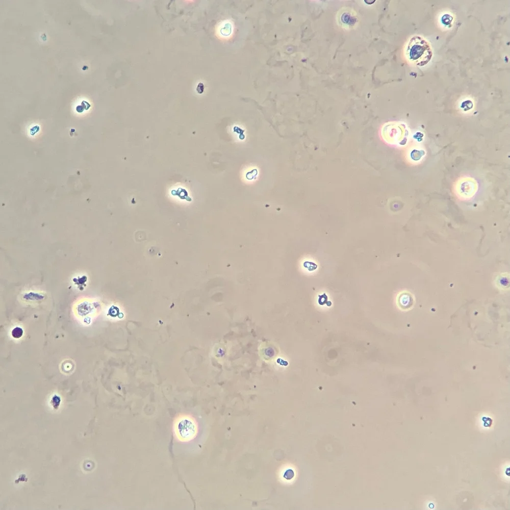 Rbcs In Urine