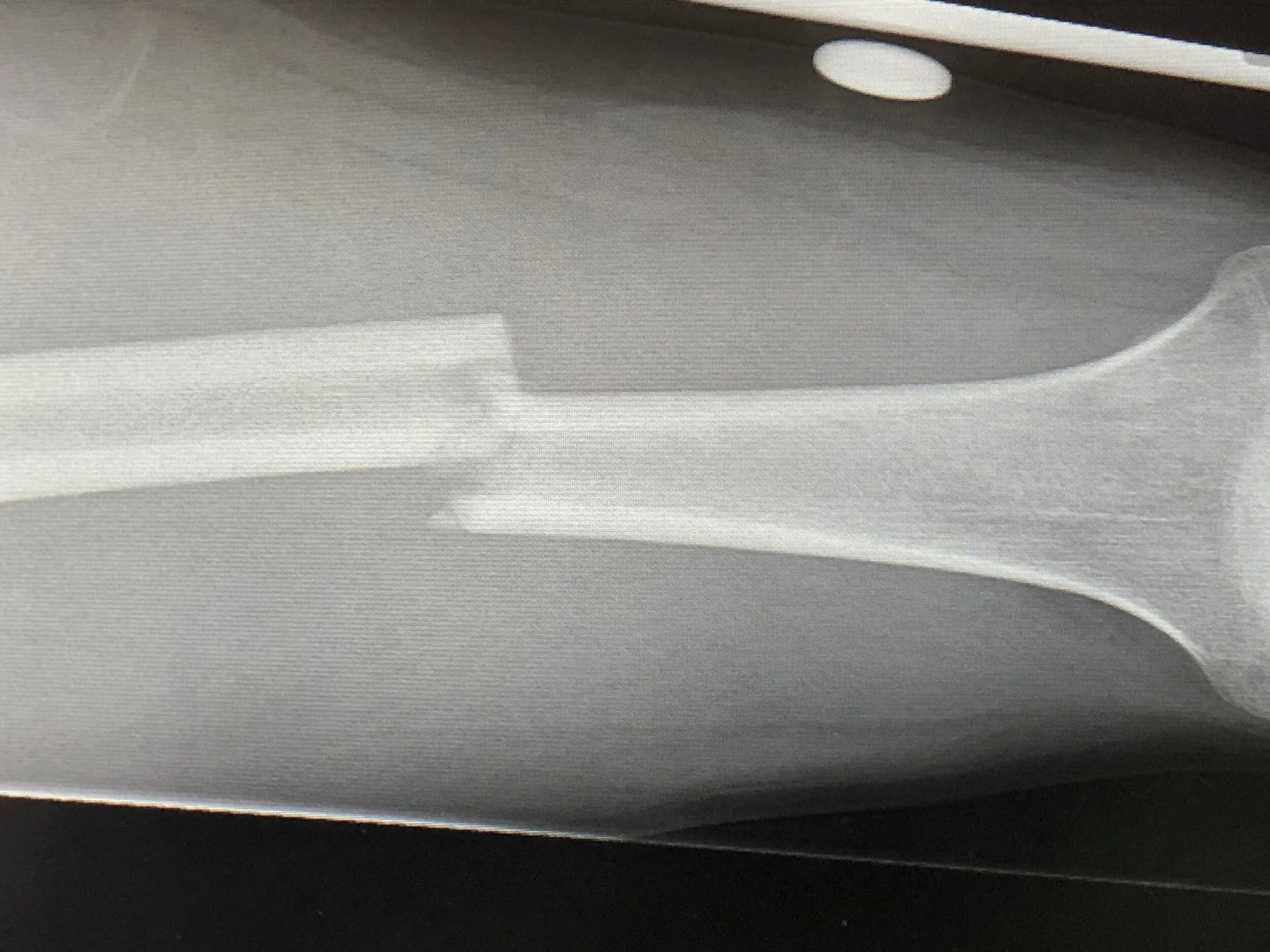 Broken Leg Bones Sticking Out